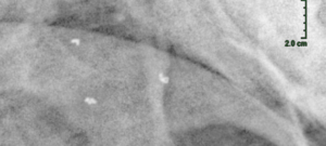 Brainlab ExacTrac Dynamic® - Gold Anchor Marker